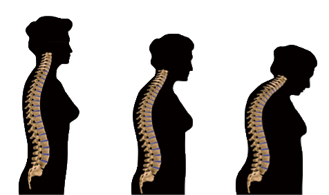 The Incredible Shrinking Woman - Ultimate Bone Support